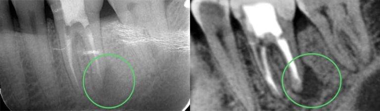 Cone Beam CT Scan vs. Traditional Dental Radiographs